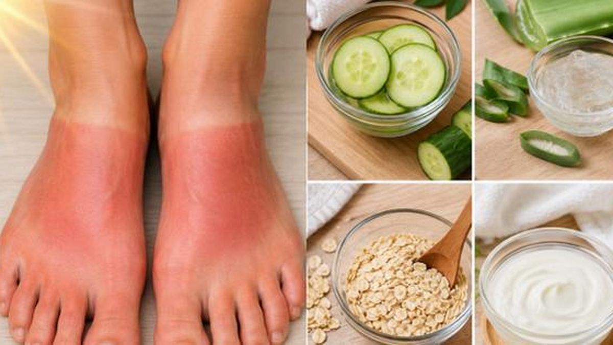 5 cách tự nhiên giúp làm dịu, cải thiện tình trạng cháy nắng ở bàn chân ...